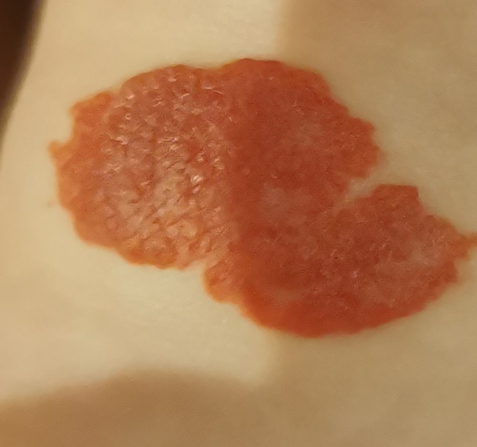 Naczyniak jamisty - czy wymaga leczenia